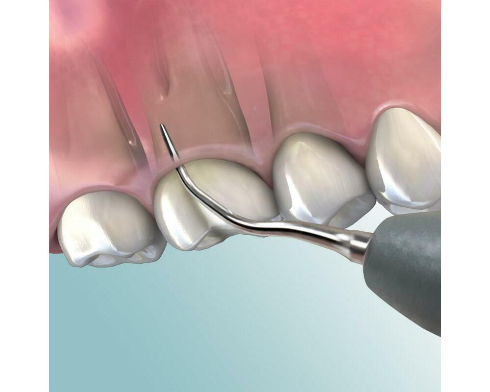 Swivel Insert Direct Flow Triple Bend XT 30K | UI30SDXTTB | Supply Clinic
