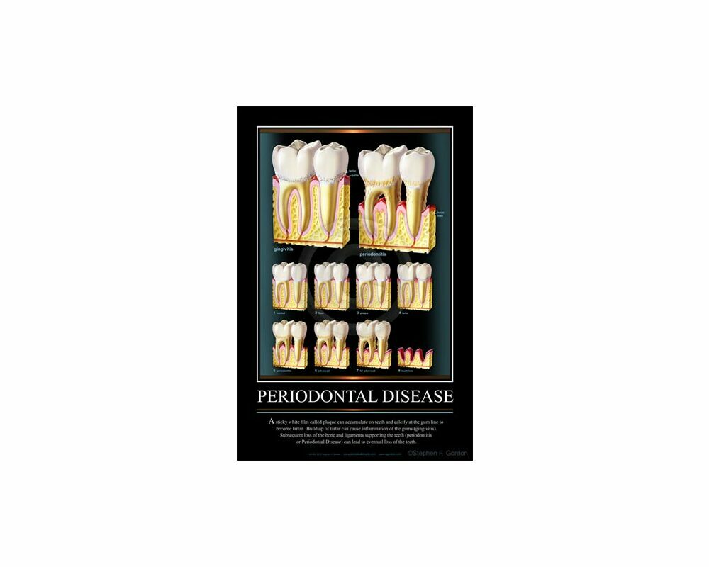 Periodontal Disease Poster | DWC601 | Supply Clinic